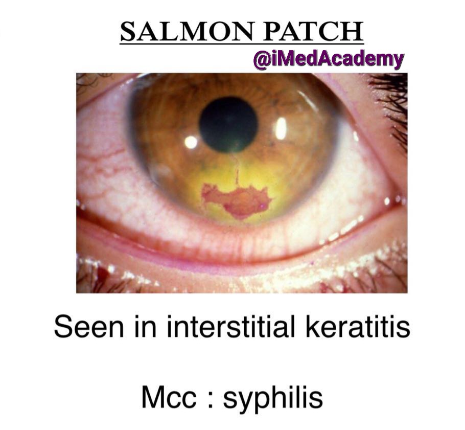 Interstitial Keratitis Salmon Patch