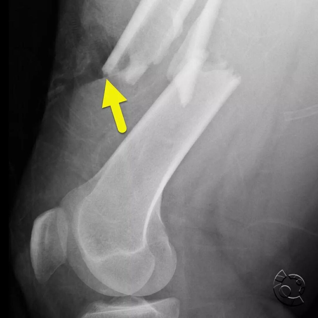 Open Femur Fracture Fractured Femur: Causes, Symptoms, And Treatment