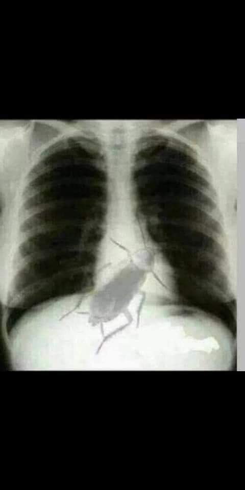 😄😄😄 This xray belongs to Funsho, whose doctors here in Nigeria told he ...