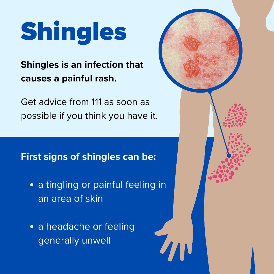 Shingles Early Symptoms