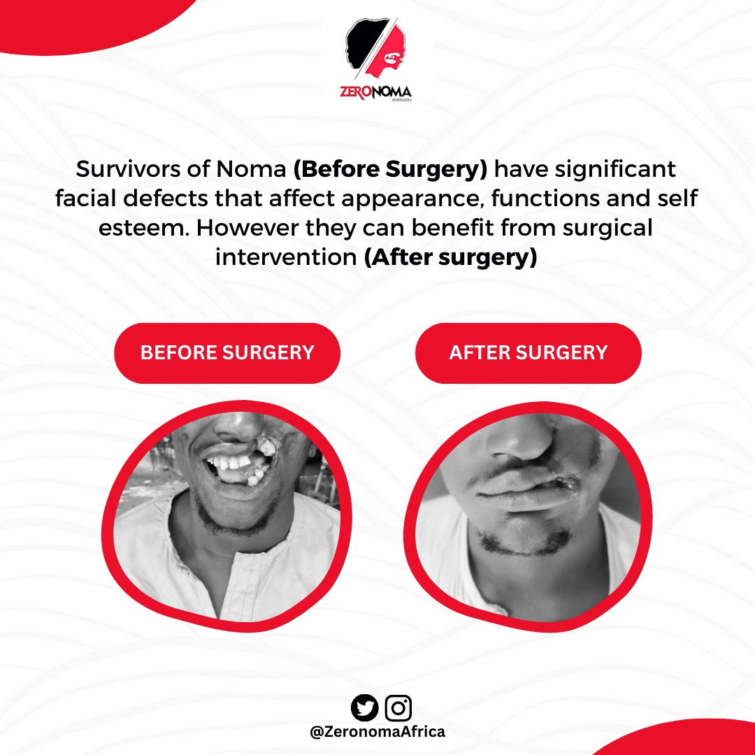 Noma Before And After