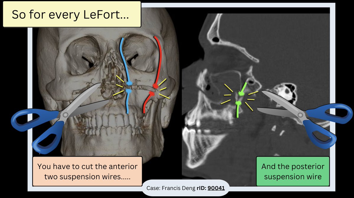 1/Feeling broken up when it comes to LeFort fractures? My fellows ...