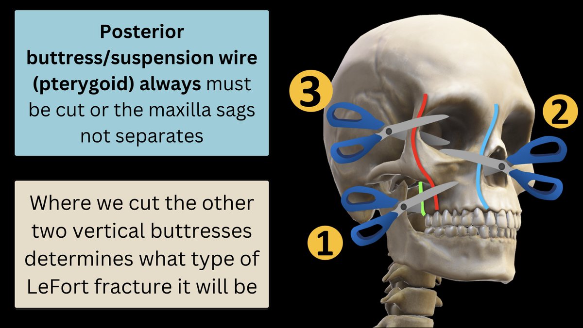 1/Feeling broken up when it comes to LeFort fractures? My fellows ...