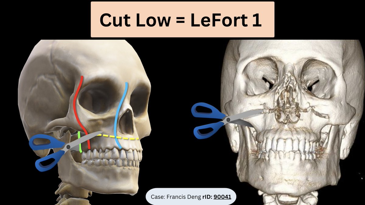 1/Feeling broken up when it comes to LeFort fractures? My fellows ...