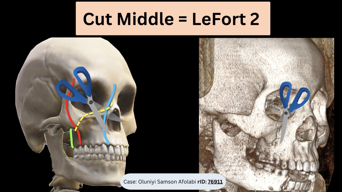 1/Feeling broken up when it comes to LeFort fractures? My fellows ...