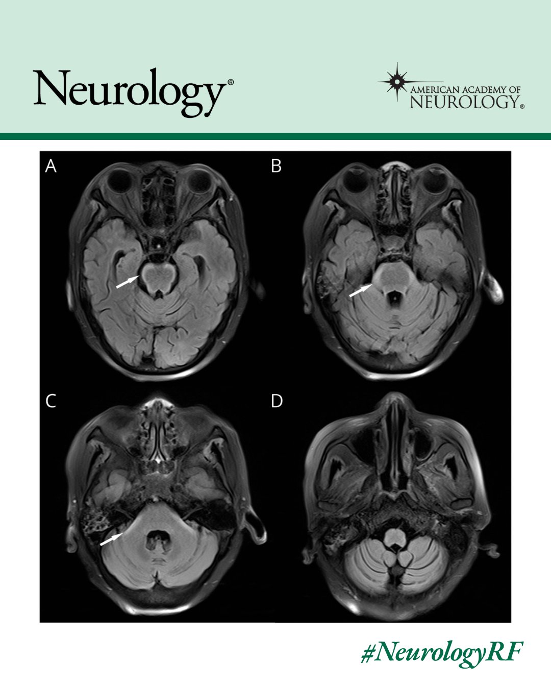 Normal Pons Mri EPOS™