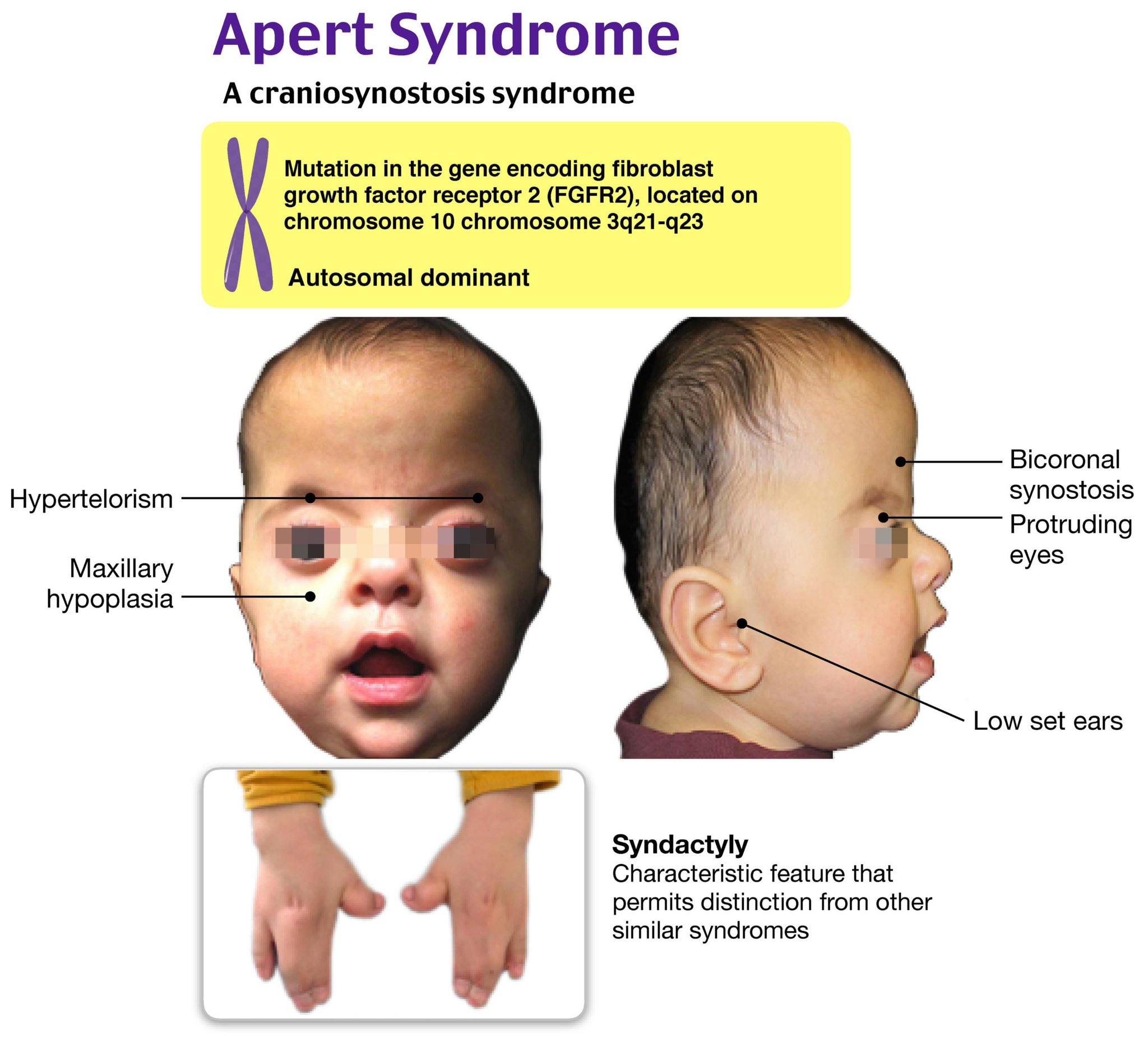 Apert Syndrome
