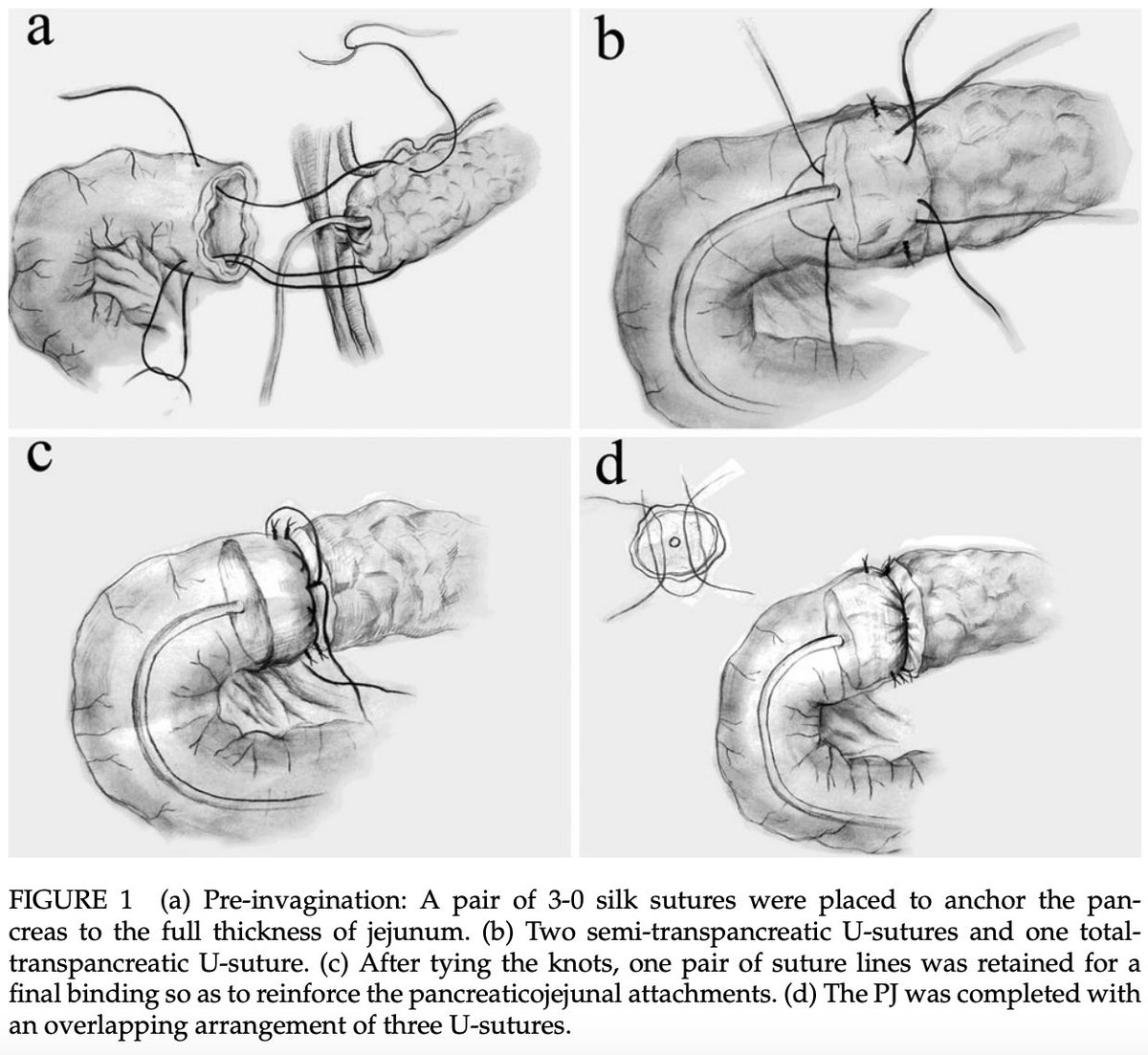 🚨🚨🚨🚨 Which is the best technique (Tx) for a pancreatico-enteric ...