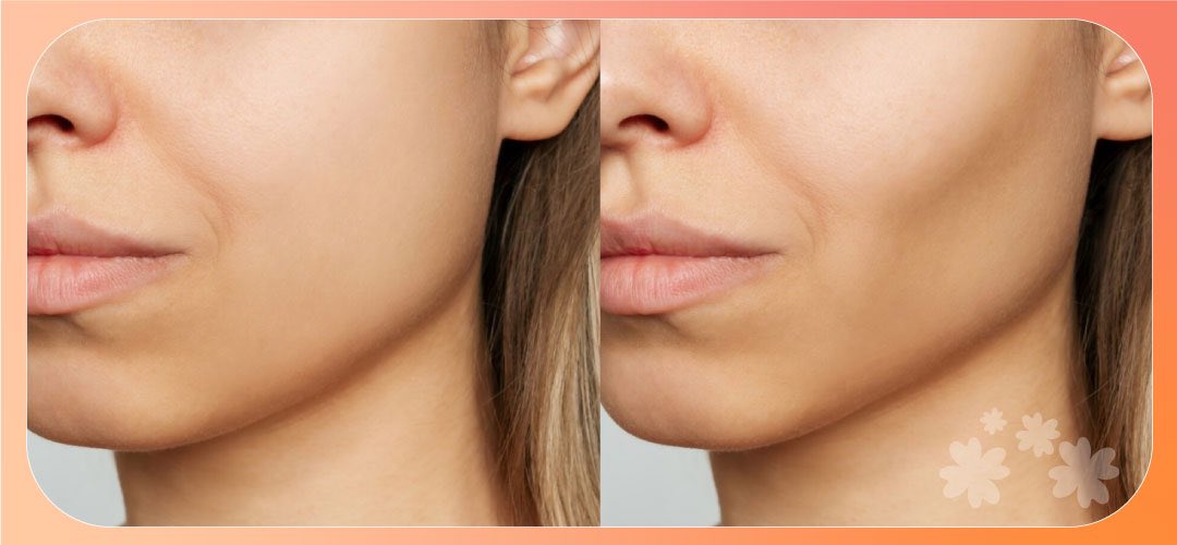 #ثريد تجميل الوجه والفكين بإزالة الدهون الخديه يمكن أن يعزز من جمال ...