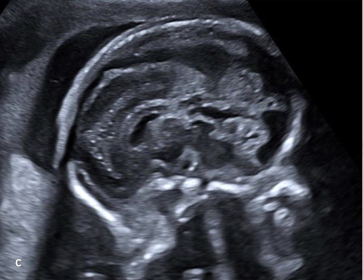 Agenesis Of The Corpus Callosum Ultrasound