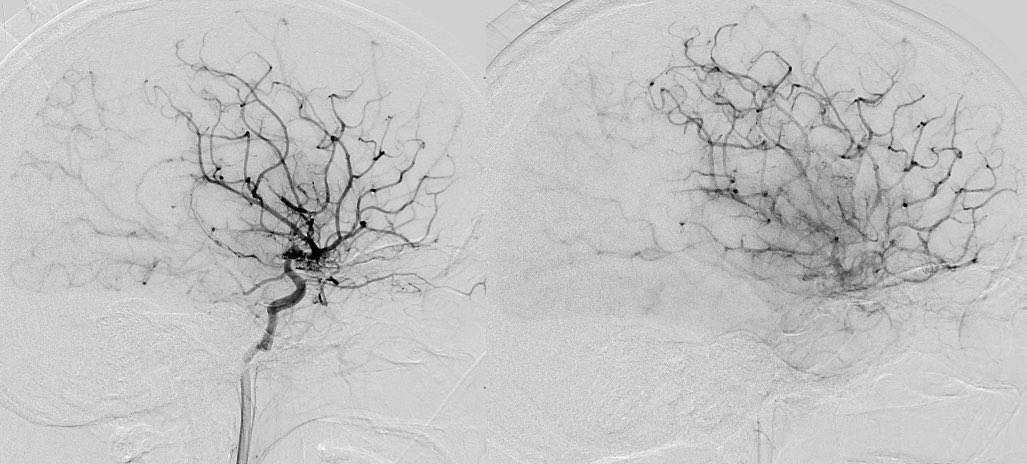 Moyamoya disease/syndrome Imaging: Thread-like intracranial ICA/MCA ...