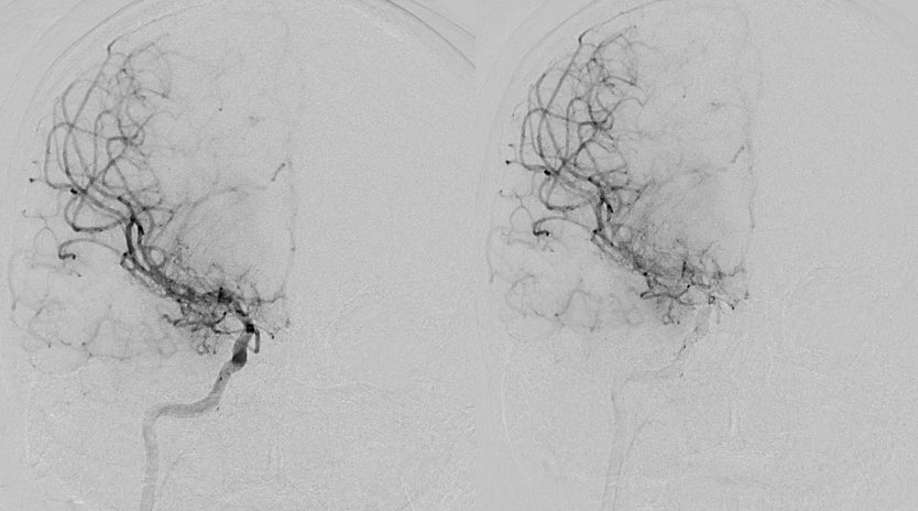 Moyamoya disease/syndrome Imaging: Thread-like intracranial ICA/MCA ...