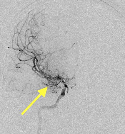 Moyamoya disease/syndrome Imaging: Thread-like intracranial ICA/MCA ...
