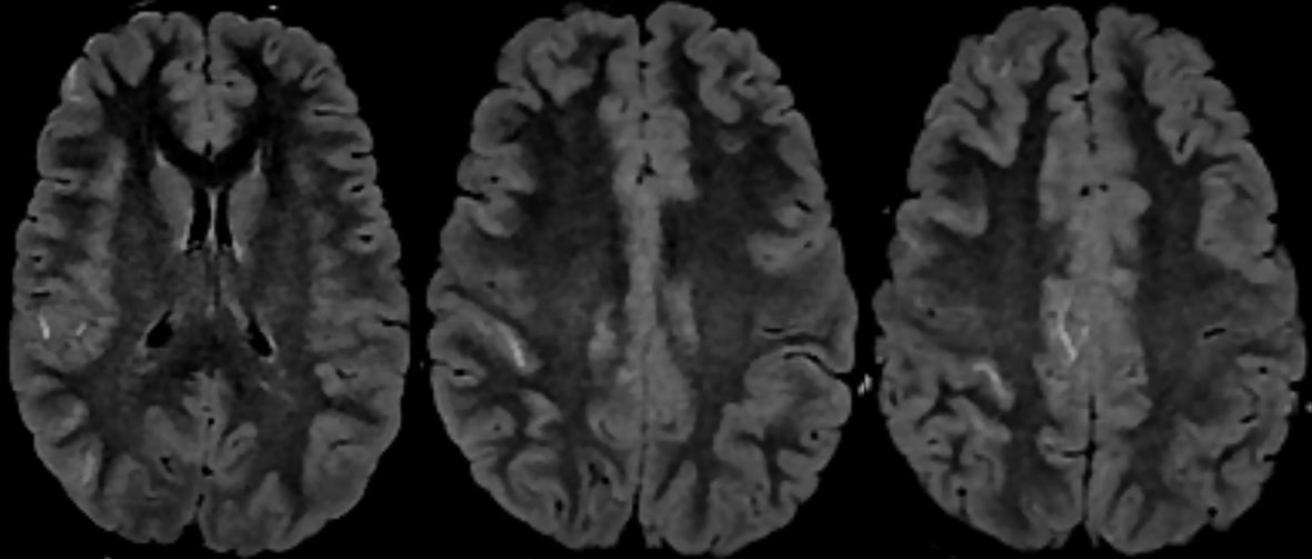 Moyamoya disease/syndrome Imaging: Thread-like intracranial ICA/MCA ...
