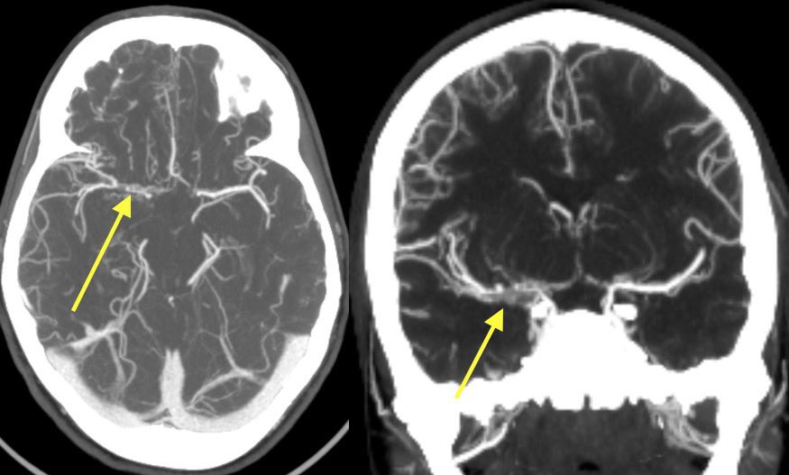 Moyamoya disease/syndrome Imaging: Thread-like intracranial ICA/MCA ...