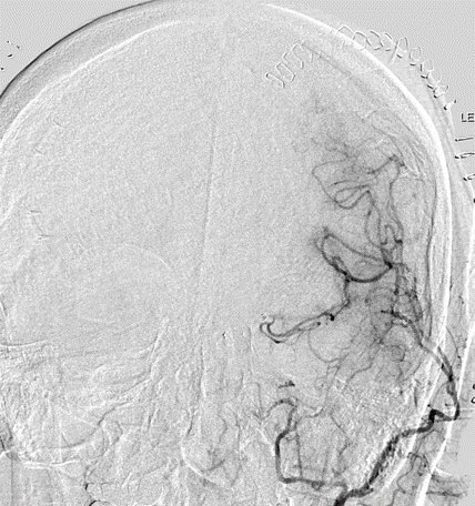 Moyamoya disease/syndrome Imaging: Thread-like intracranial ICA/MCA ...