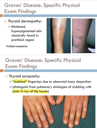 Pretibial Myxedema Graves Dermopathy