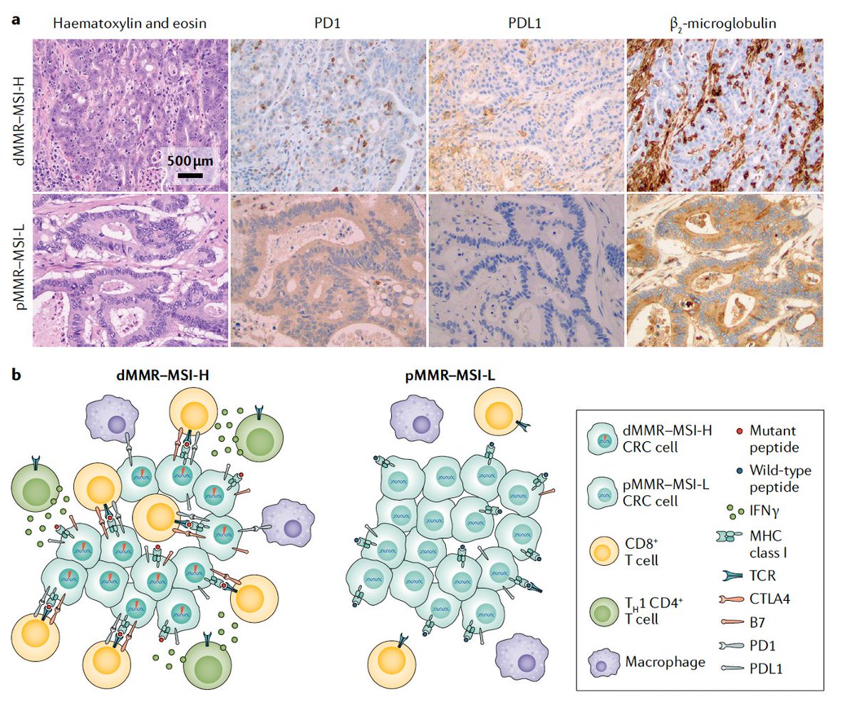 @TumorBoardTues 1/20 #TumorBoardTuesday #ColonCancer #OncTwitter 58yo 👩 ...
