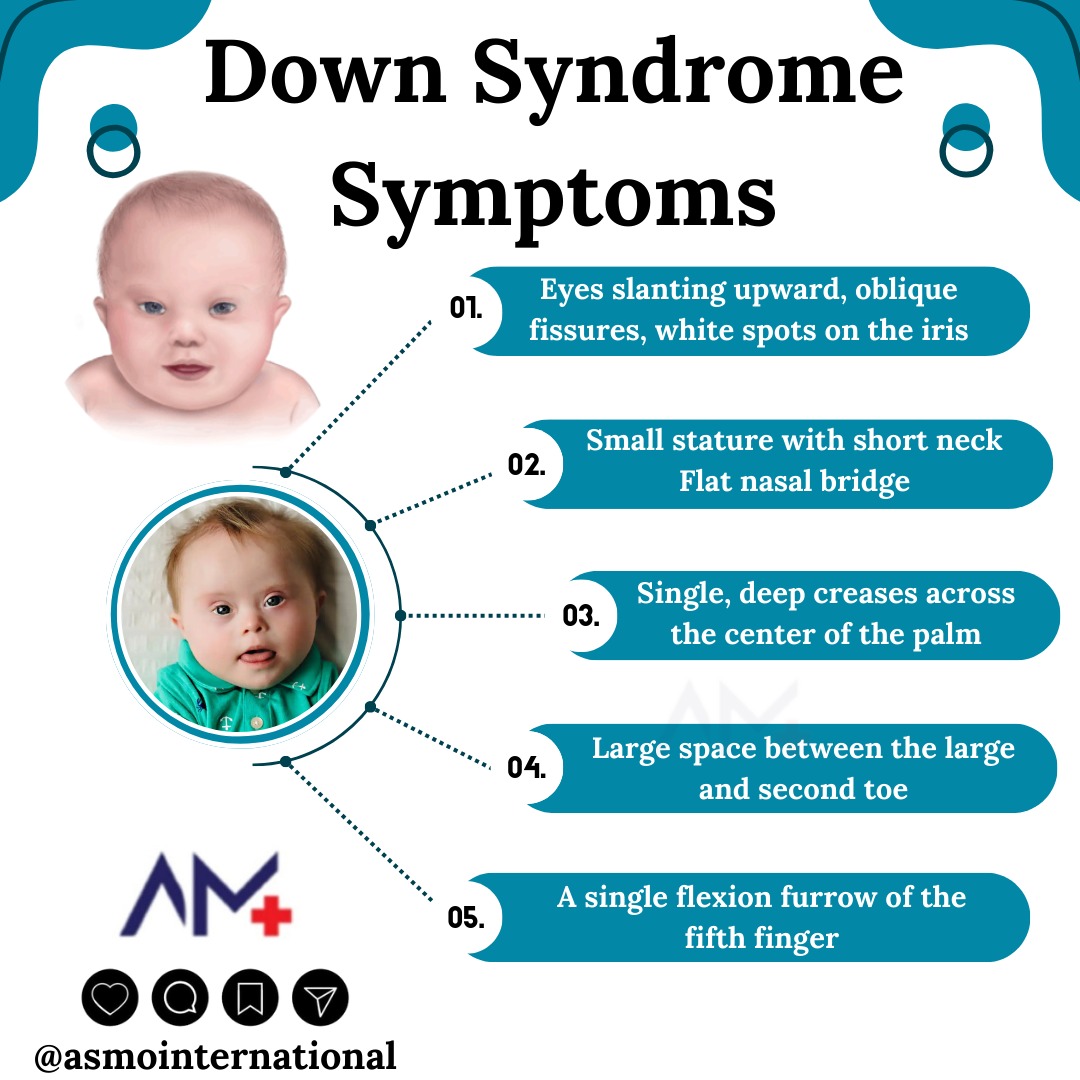 Down Syndrome Symptoms