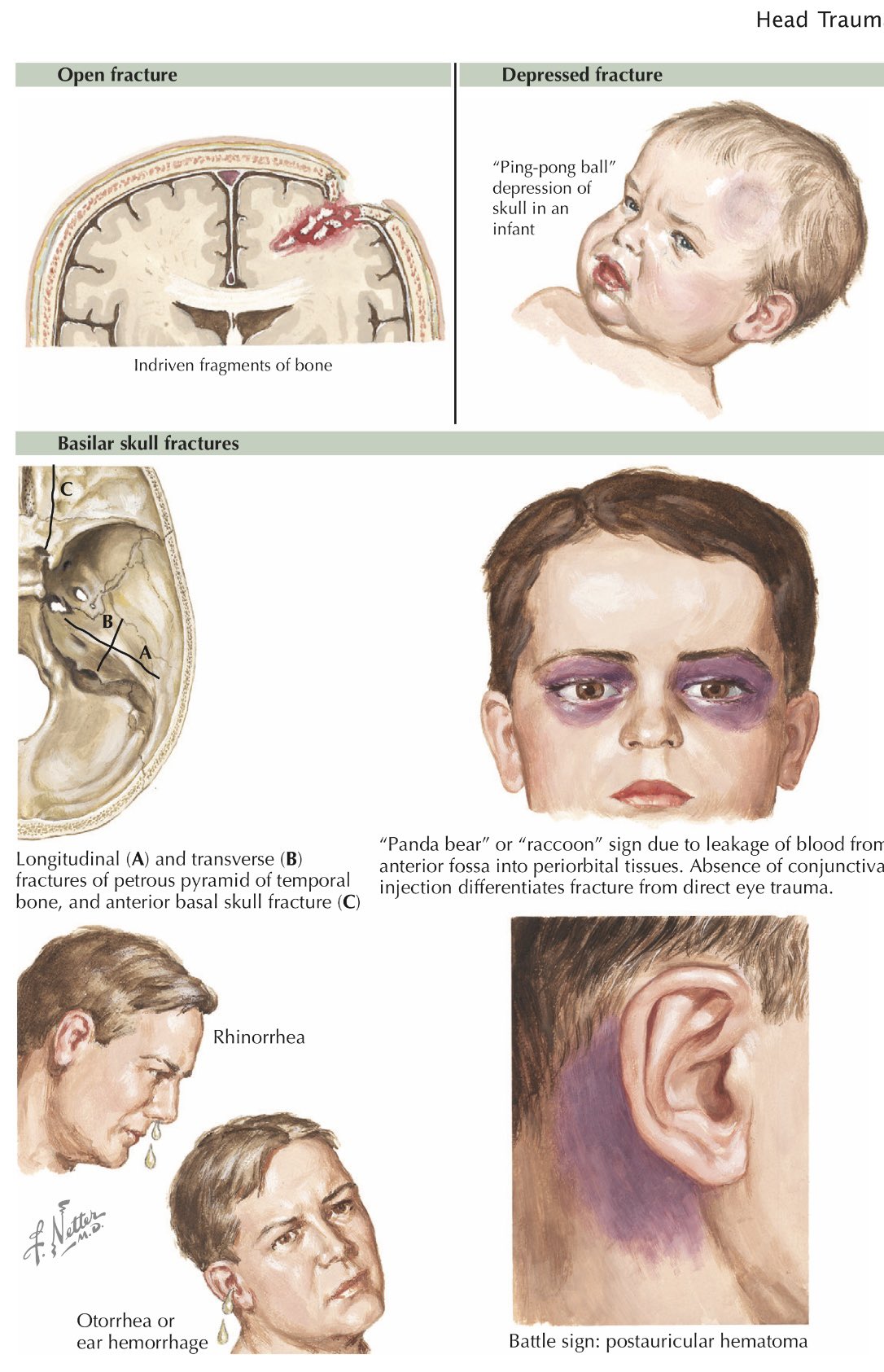 Fracture Petrous Pyramid