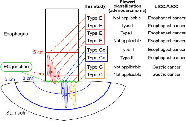 🚨 🚨 🚨 Should cancers of the esophagogastric junction be managed as ...