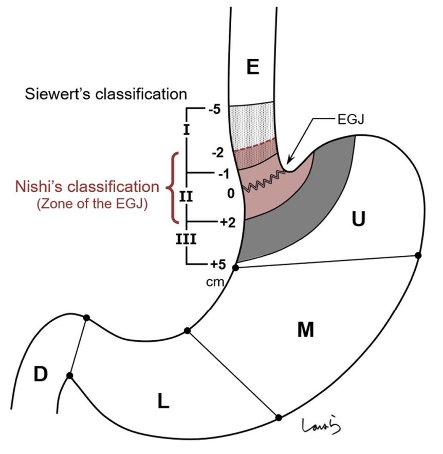 🚨 🚨 🚨 Should cancers of the esophagogastric junction be managed as ...