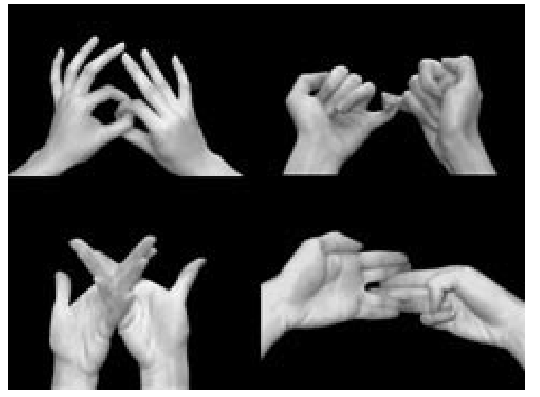 Corticobasal Syndrome (CBS): aliens among us 👽 Clinical symptoms and ...