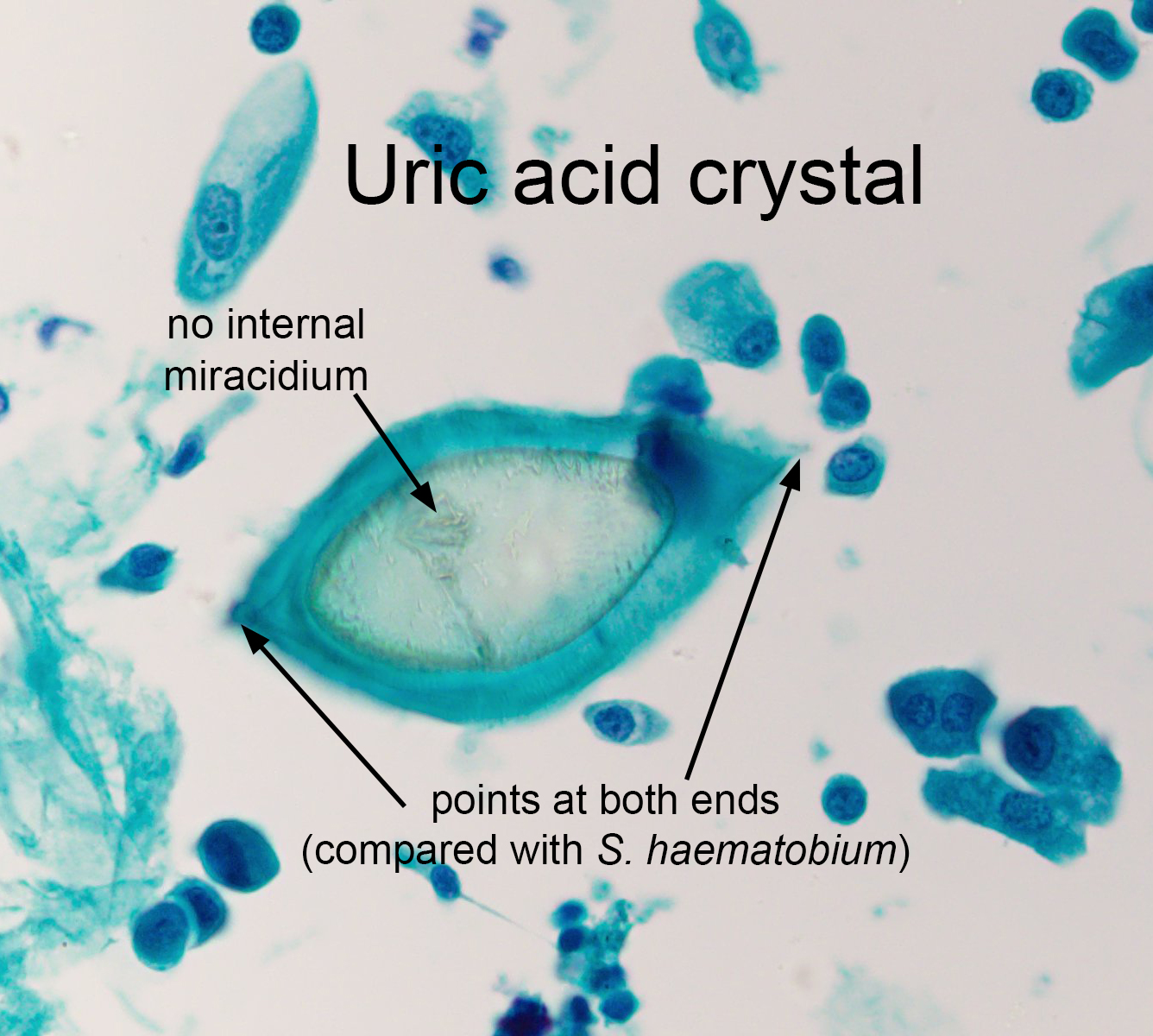 Uric Acid Crystals In Urine Differential Identification Of Urine