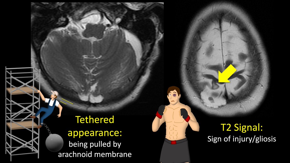 It’s not everyday you get to see the brain explode into its coverings ...