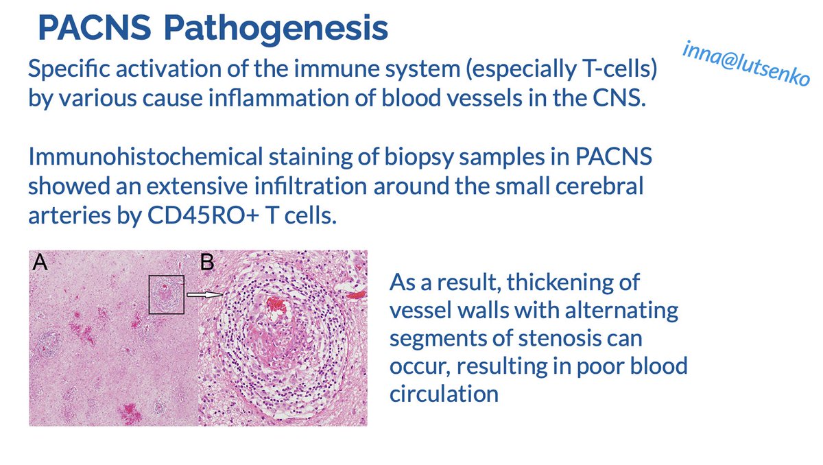 A 🧵 about PACNS: SPOILER: with @ESOstroke Guidelines! ️primary # ...