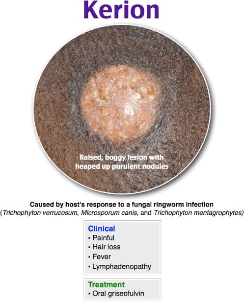Tinea Capitis Kerion