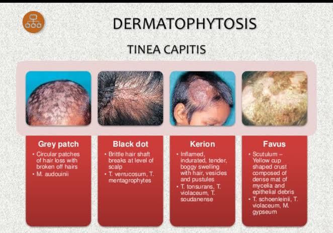 Tinea Capitis Kerion