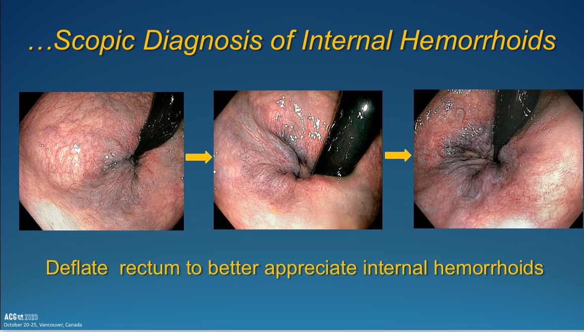 Internal Hemorrhoids Colonoscopy Hemorrhoids And Related The