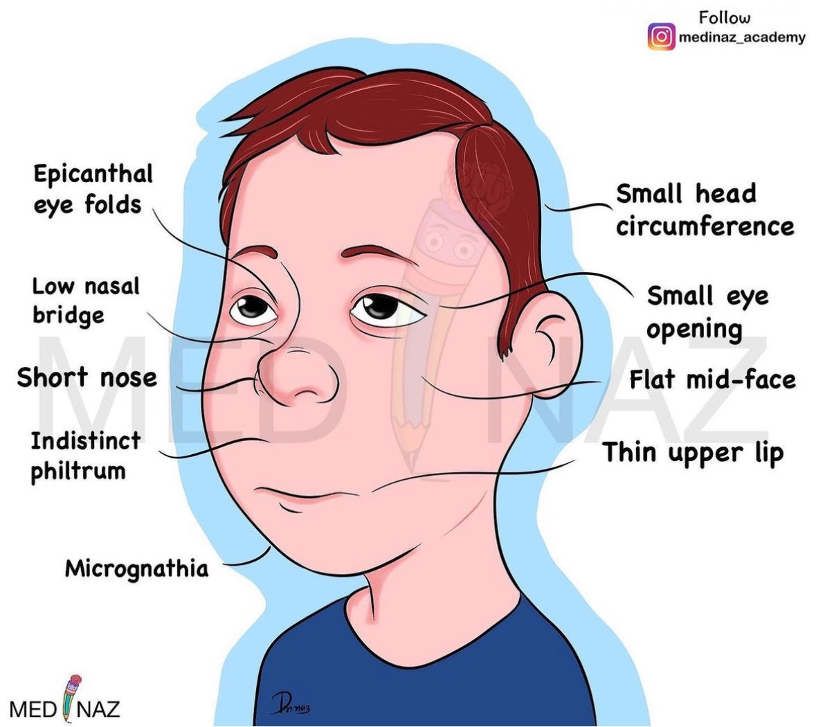 Fetal Alcohol Syndrome Adults Face