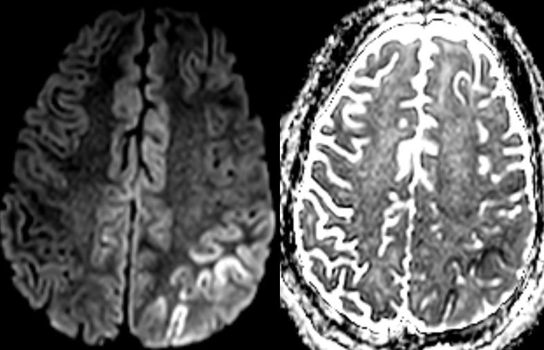 Acute Seizure related imaging findings 💡 Common locations for Diffusion ...
