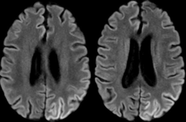 Acute Seizure related imaging findings 💡 Common locations for Diffusion ...