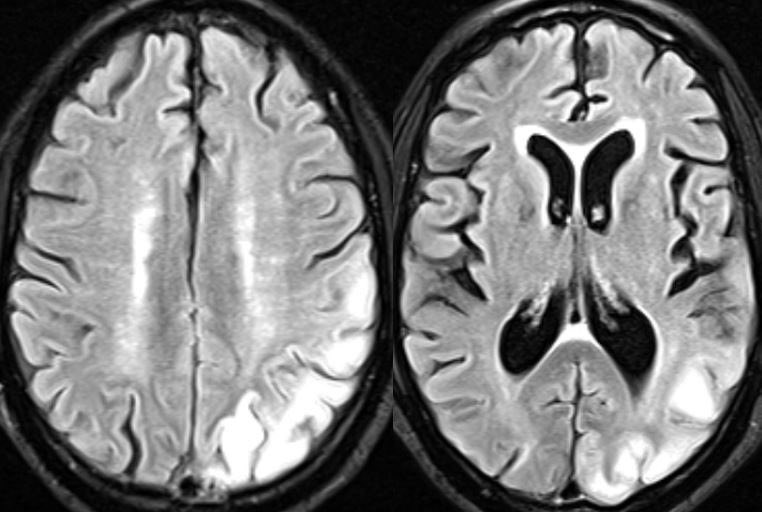 Acute Seizure related imaging findings 💡 Common locations for Diffusion ...