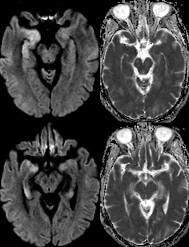 Acute Seizure related imaging findings 💡 Common locations for Diffusion ...