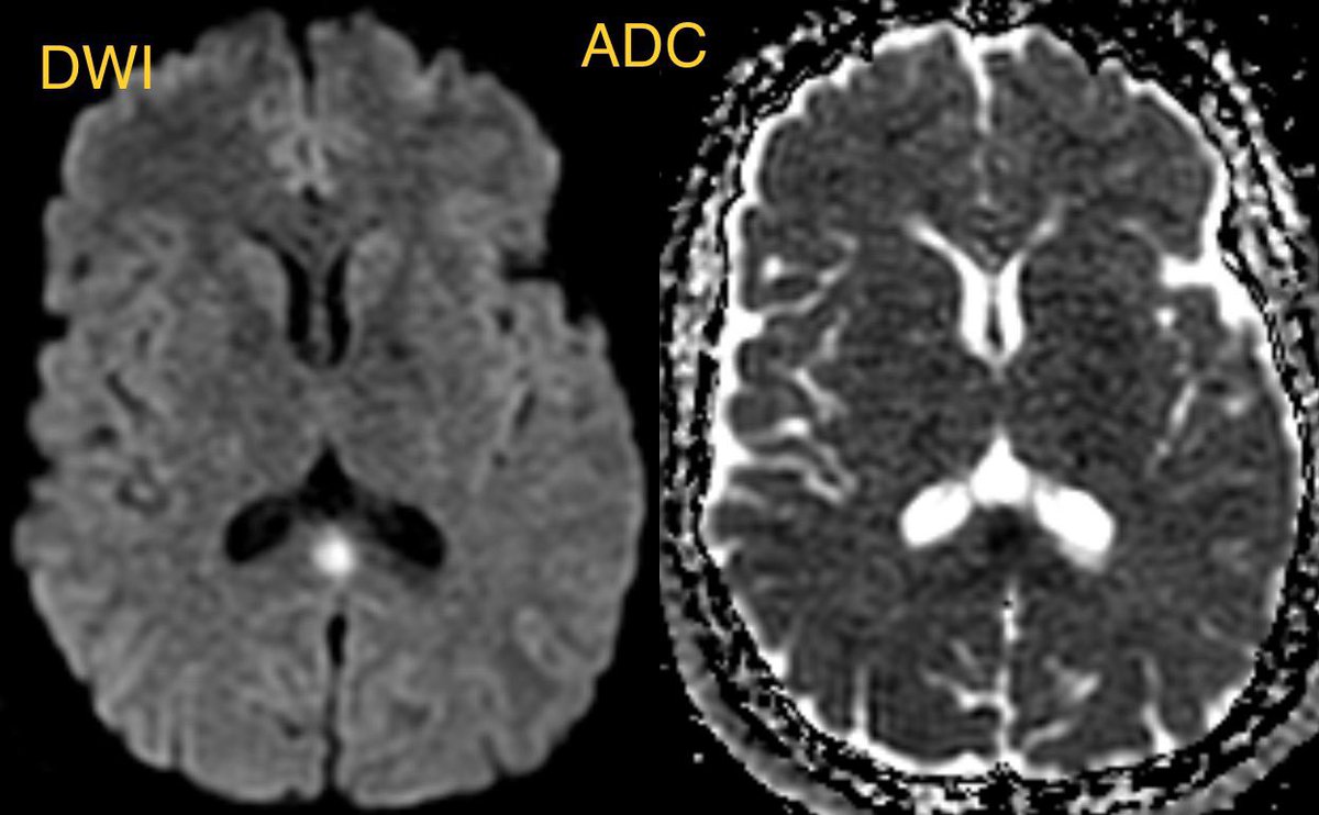 Acute Seizure related imaging findings 💡 Common locations for Diffusion ...