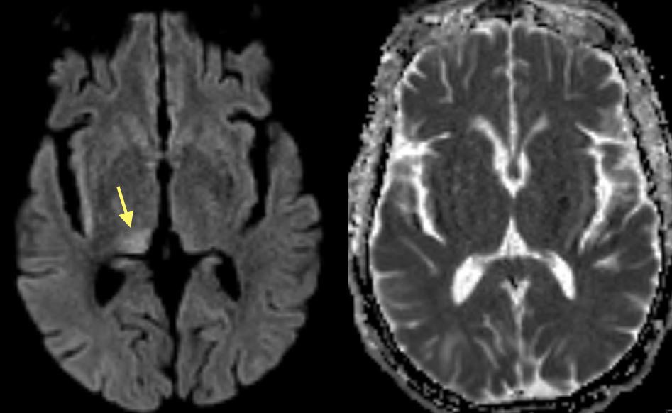Acute Seizure related imaging findings 💡 Common locations for Diffusion ...