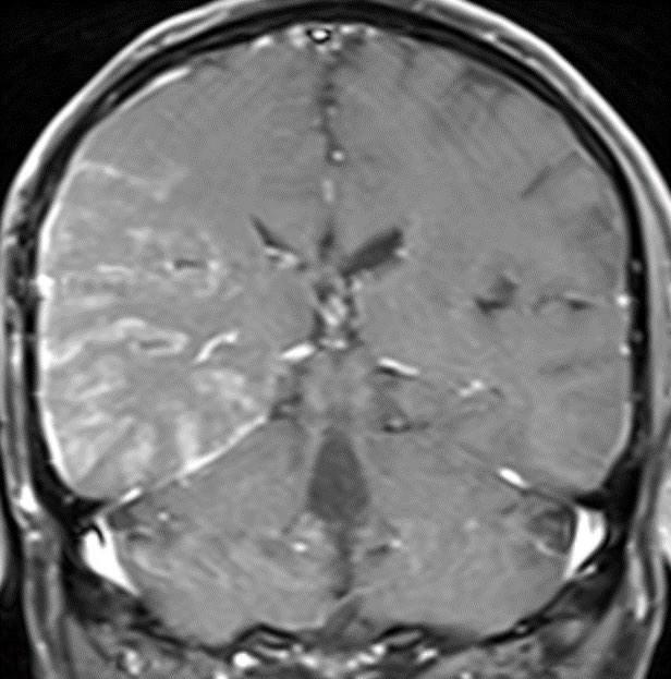Acute Seizure related imaging findings 💡 Common locations for Diffusion ...