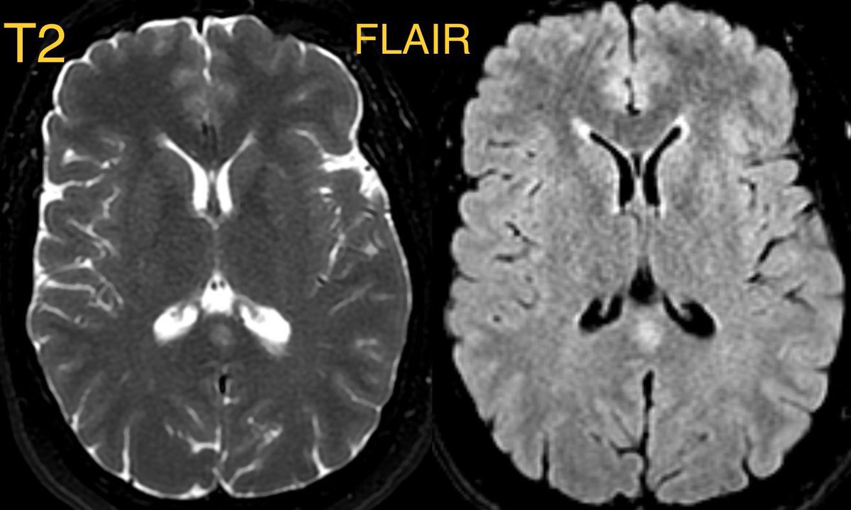 Acute Seizure related imaging findings 💡 Common locations for Diffusion ...