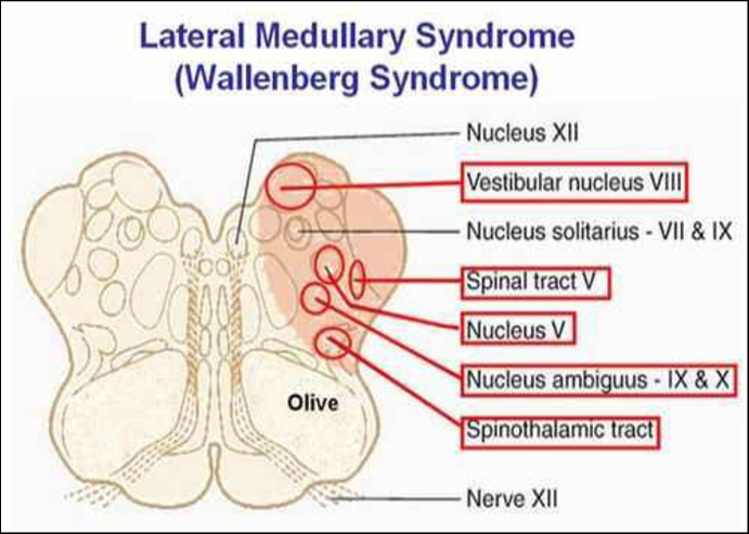 Lateral Pontine Syndrome