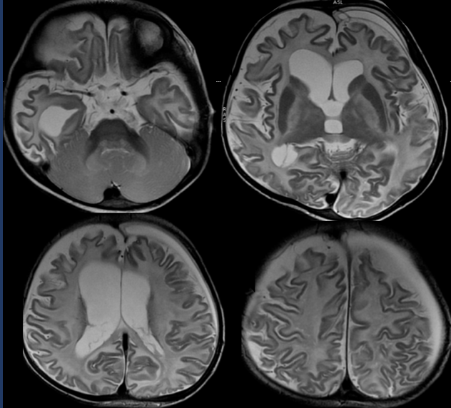 Parenchymal Atrophy Dr Kish Mankad On X: "Tip Of The Day 💡: One Of