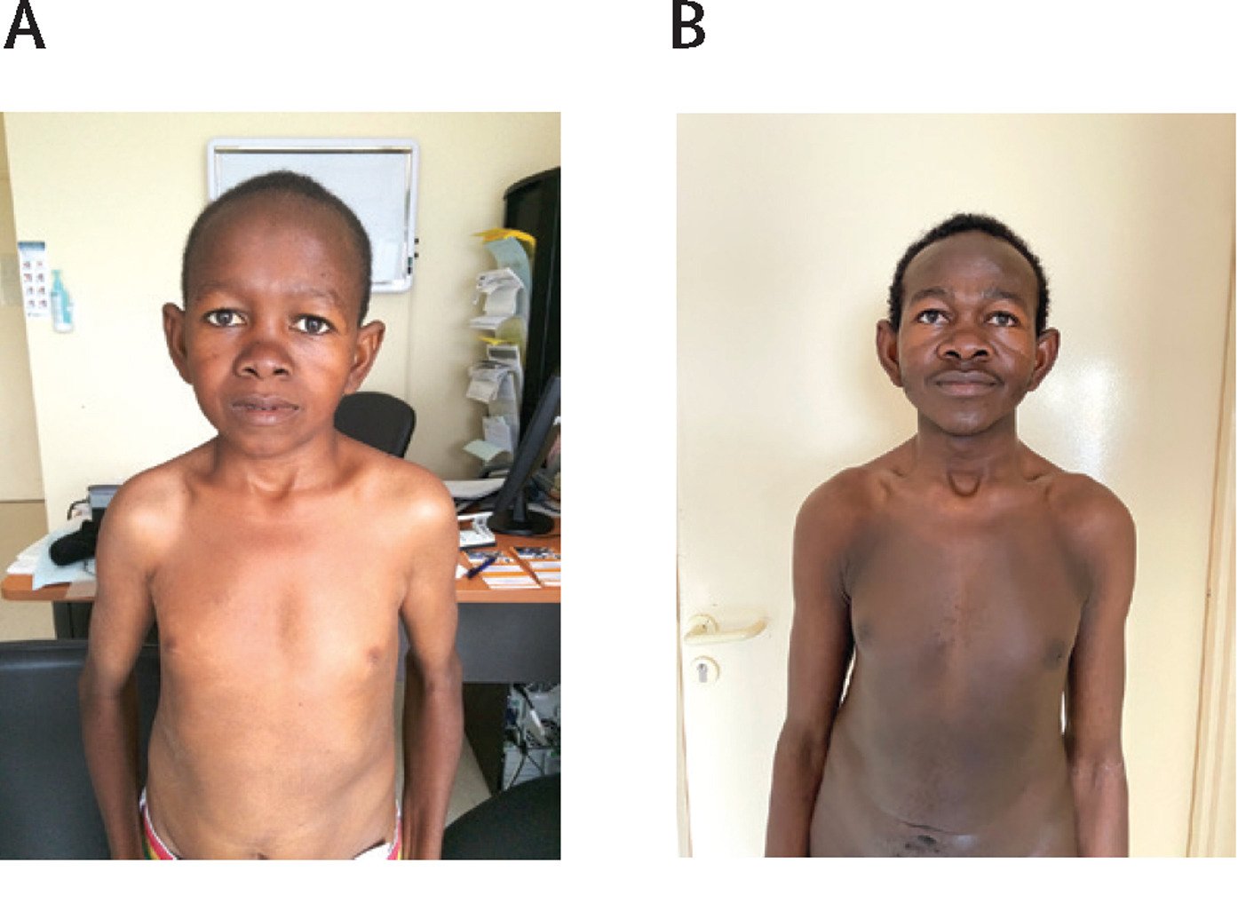 Hypopituitarism Patients