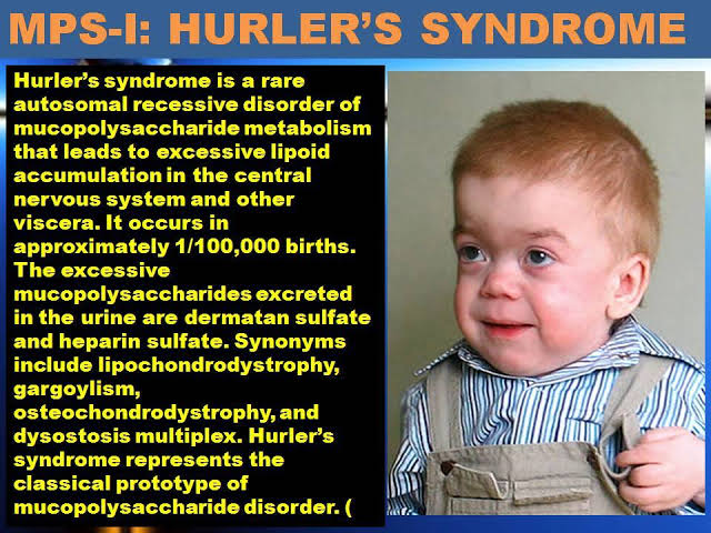 Hurler Syndrome Corneal Clouding