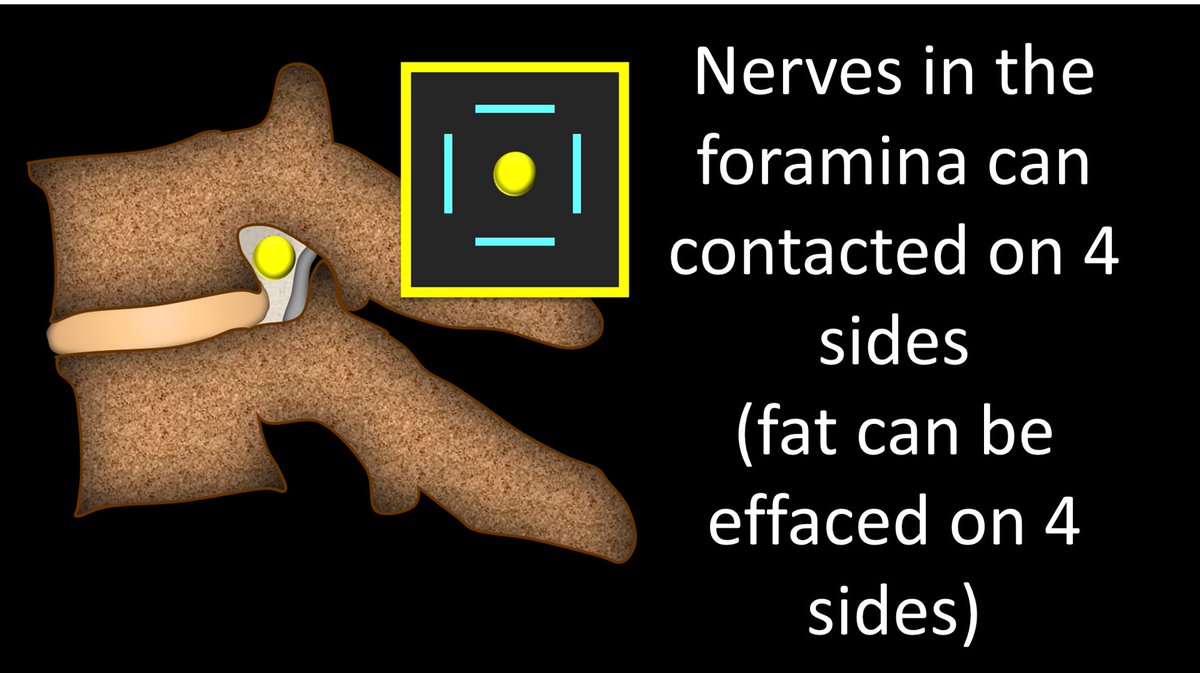 1/Hate it when one radiologist called the stenosis mild, the next one ...