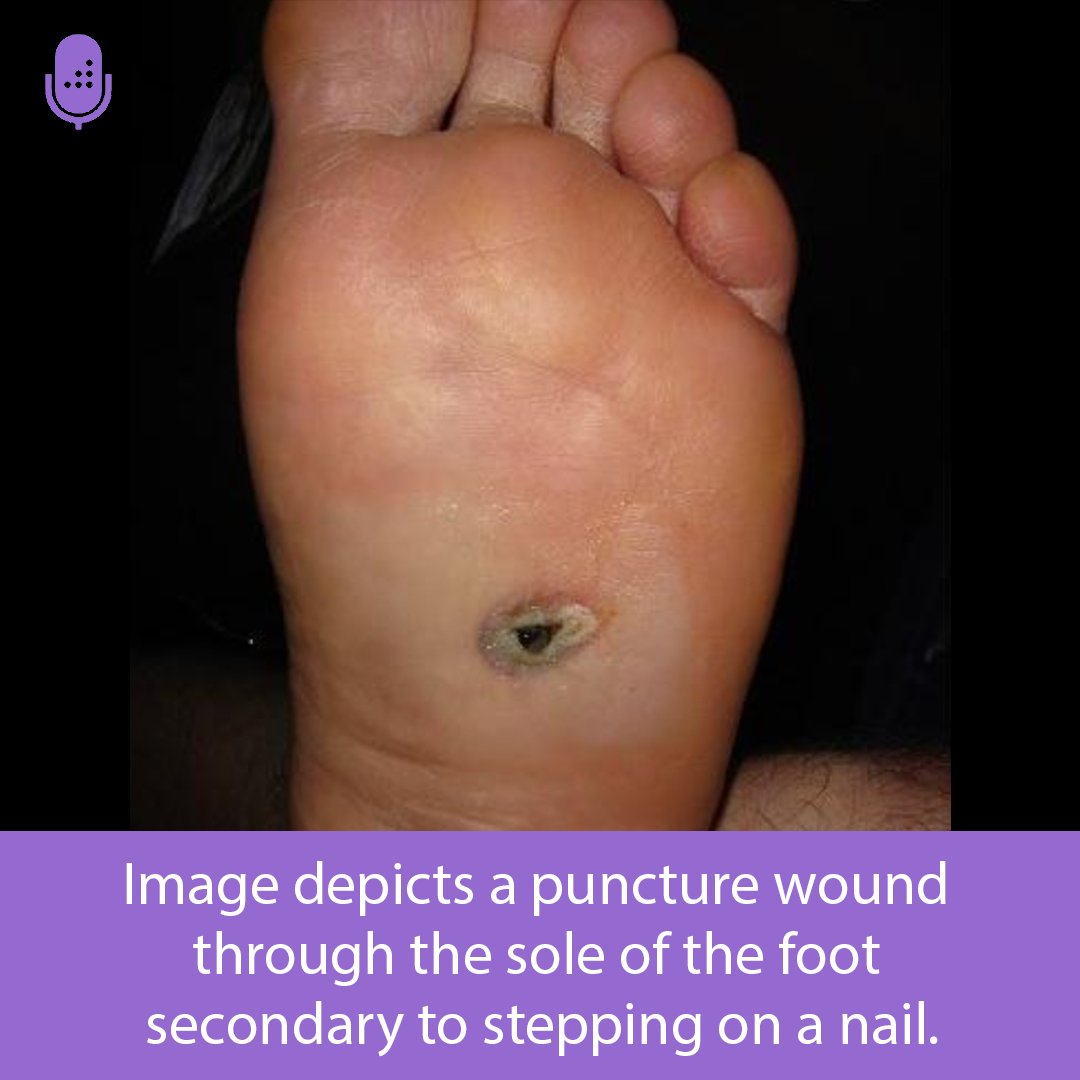 Puncture Wound