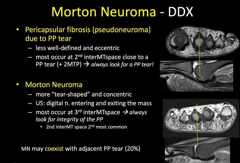 Mortons Neuroma Xray