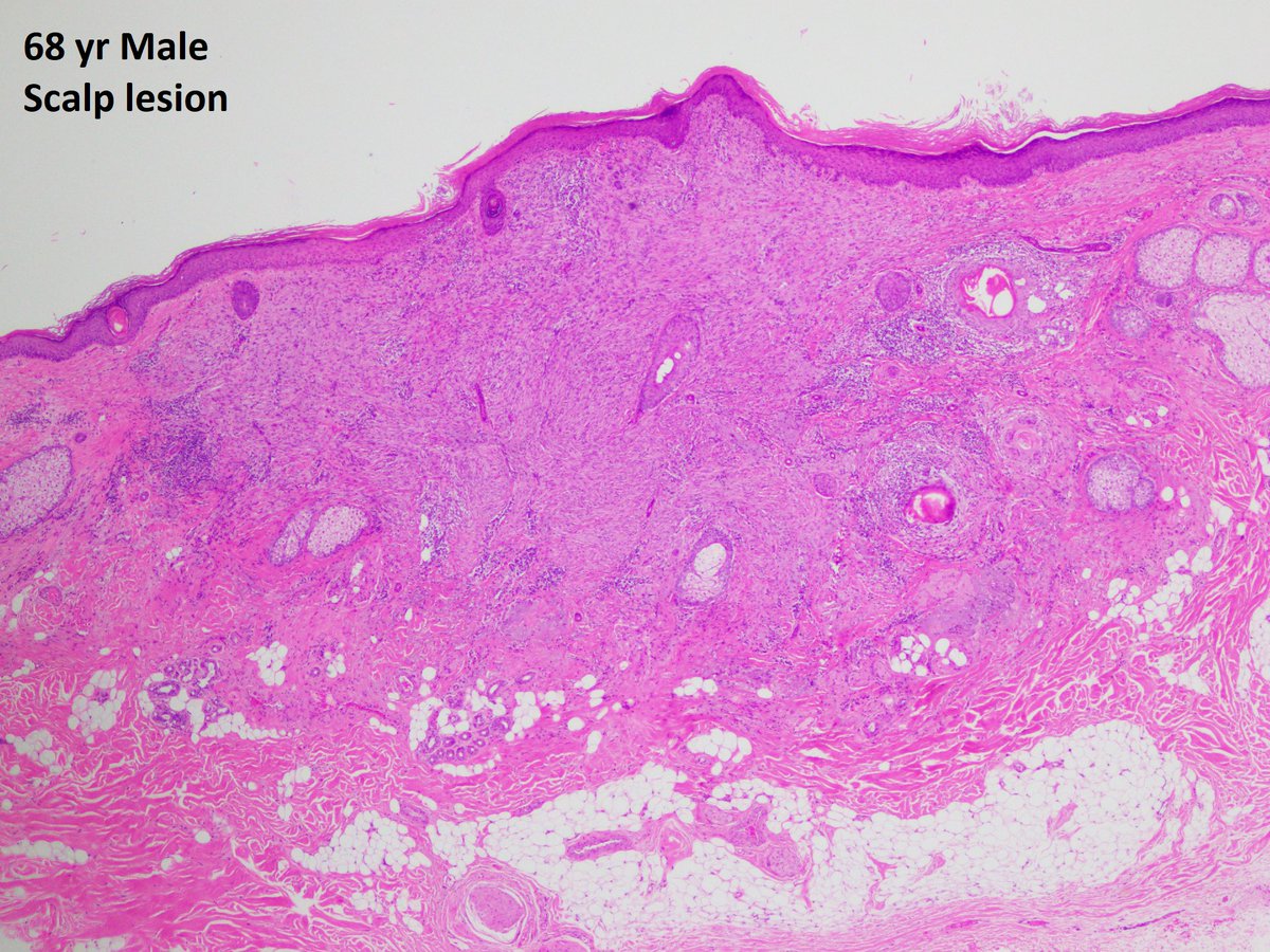 Atypical Fibroxanthoma Histology